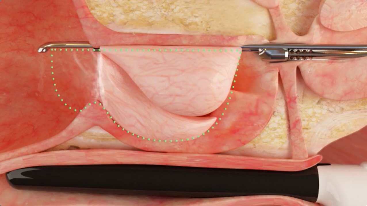 What is the Aquablation Procedure? | Aquablation® Therapy