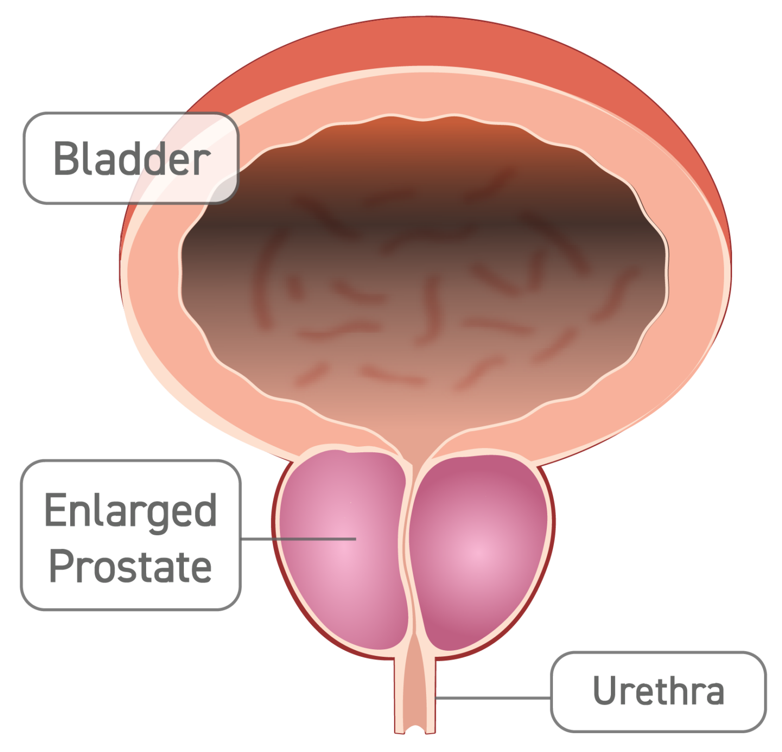 Living With BPH - Aquablation® UK